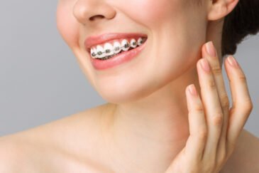 Types of Brackets and Their Uses - Alyans Clinic